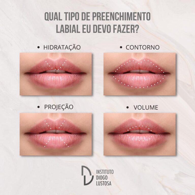 Preenchimento Labial Antes e Depois: Veja os Resultados - Instituto ...